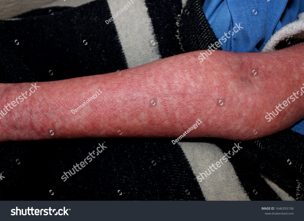 Psoriasis: The Ultimate Guide [Updated] for 2020 - Tim Grigsby