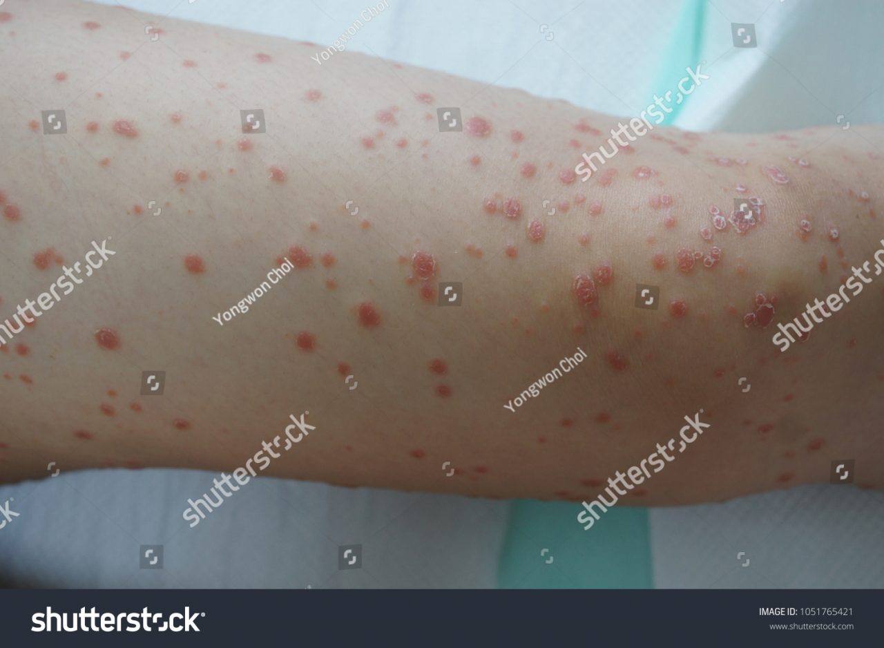Psoriasis: The Ultimate Guide [Updated] for 2020 - Tim Grigsby